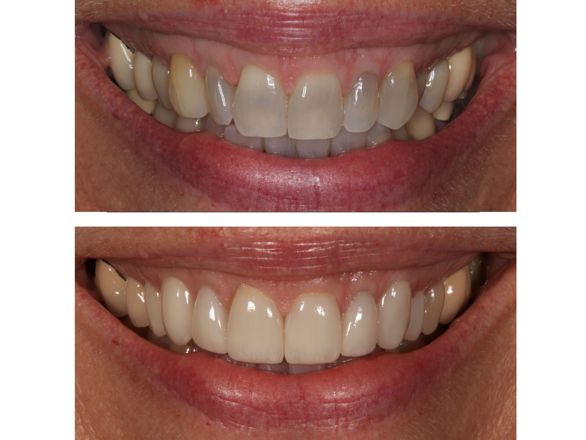 Ips E Max Cad Lithium Disilicate Block For Cad Cam Ivoclar